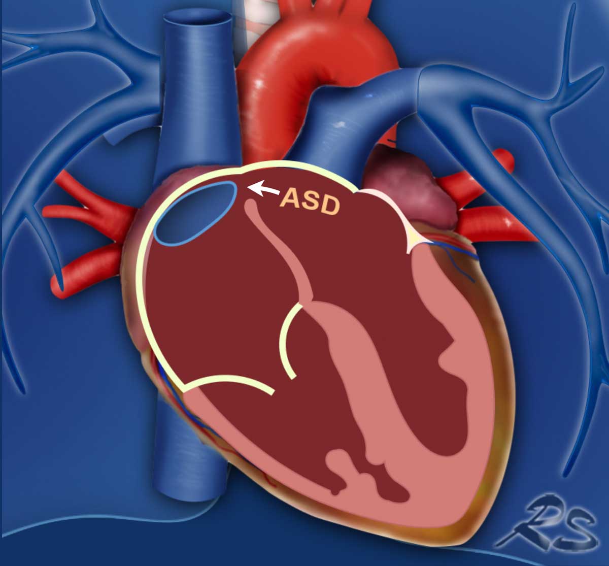 The Radiology Assistant : Pulmonary Hypertension and Thromboembolic disease