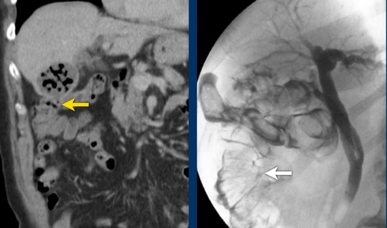 The Radiology Assistant : Gallbladder obstruction