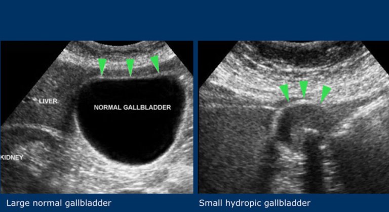 The Radiology Assistant : Gallbladder obstruction