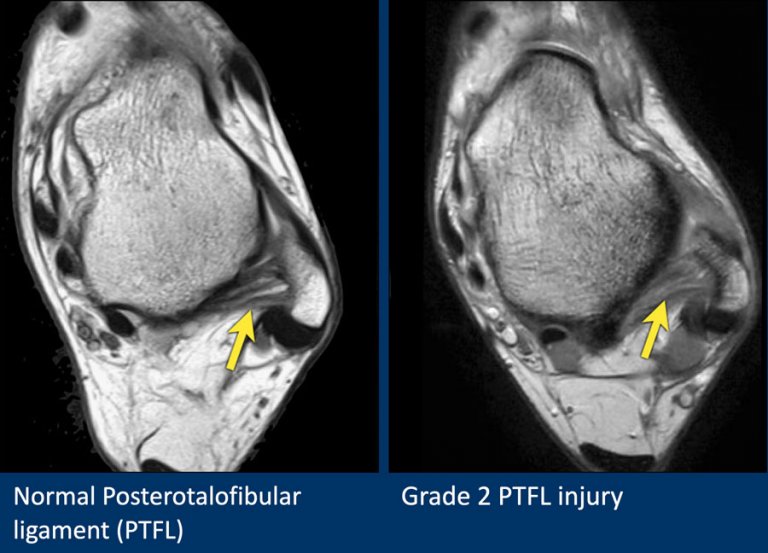 The Radiology Assistant : MRI examination of the ankle