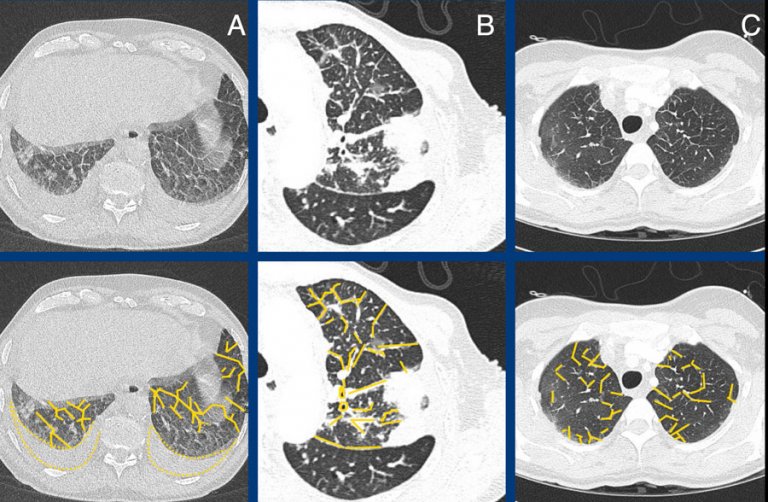 The Radiology Assistant : Pulmonary Fibrosis