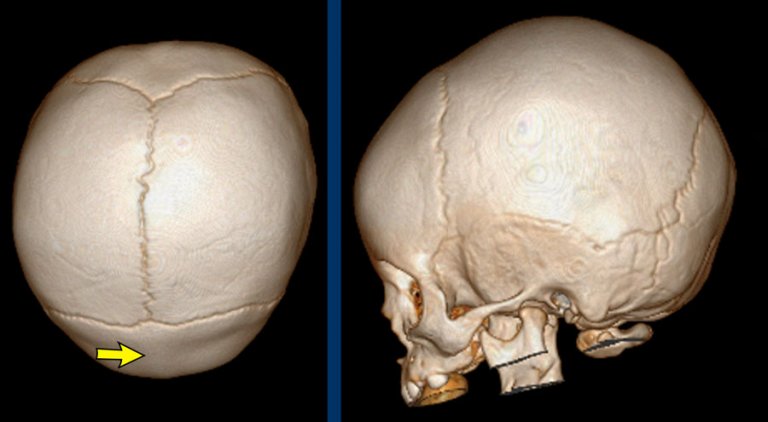 The Radiology Assistant : Craniosynostosis