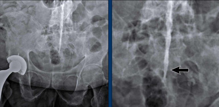 The Radiology Assistant : Arthritis