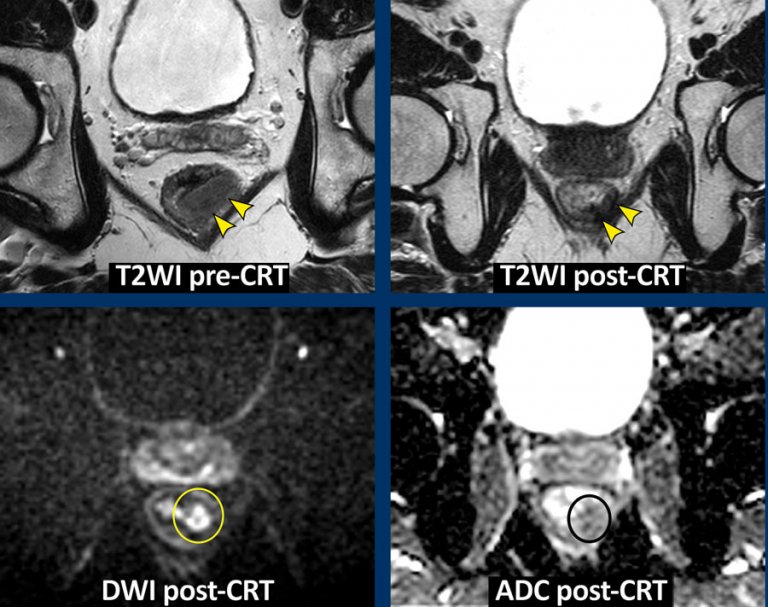 The Radiology Assistant : Rectal Cancer MR staging 3.0