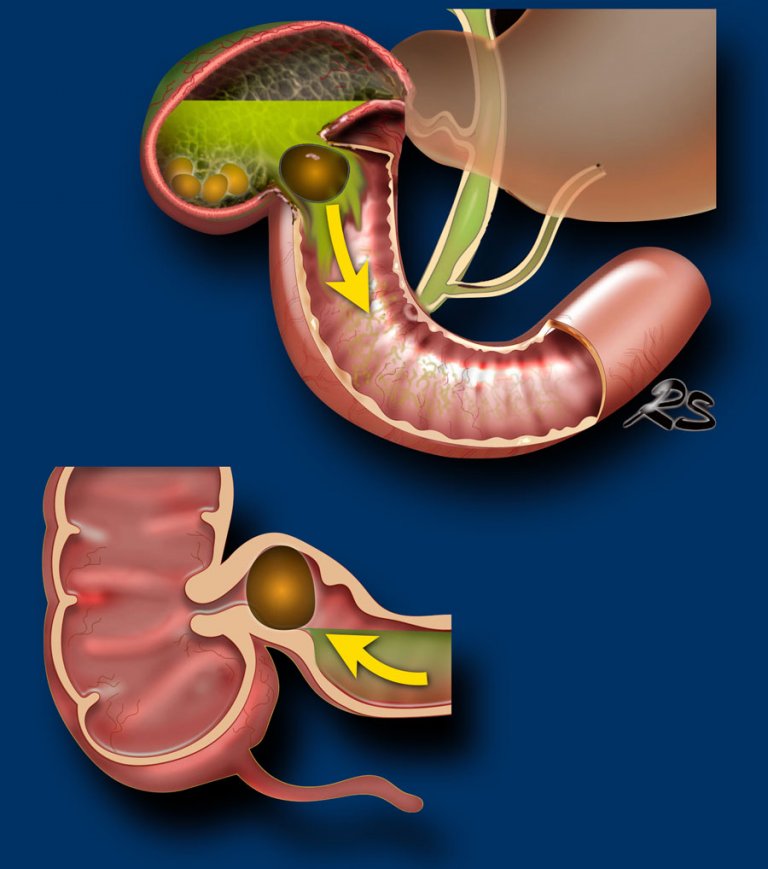 The Radiology Assistant : Gallbladder obstruction