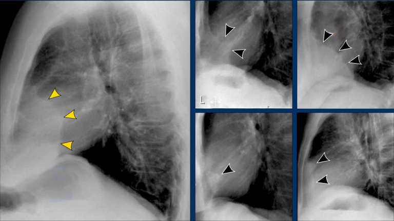 The Radiology Assistant : Chest X-Ray - Basic Interpretation