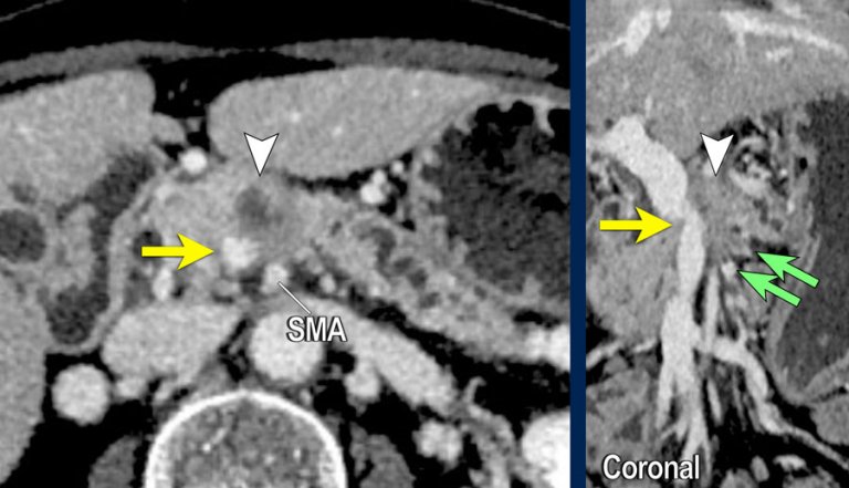 The Radiology Assistant : Pancreatic Cancer - CT staging 2.0