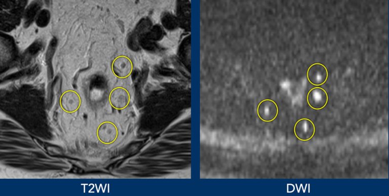 The Radiology Assistant : Rectal Cancer MR staging 3.0