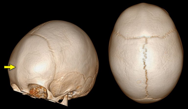 The Radiology Assistant : Craniosynostosis