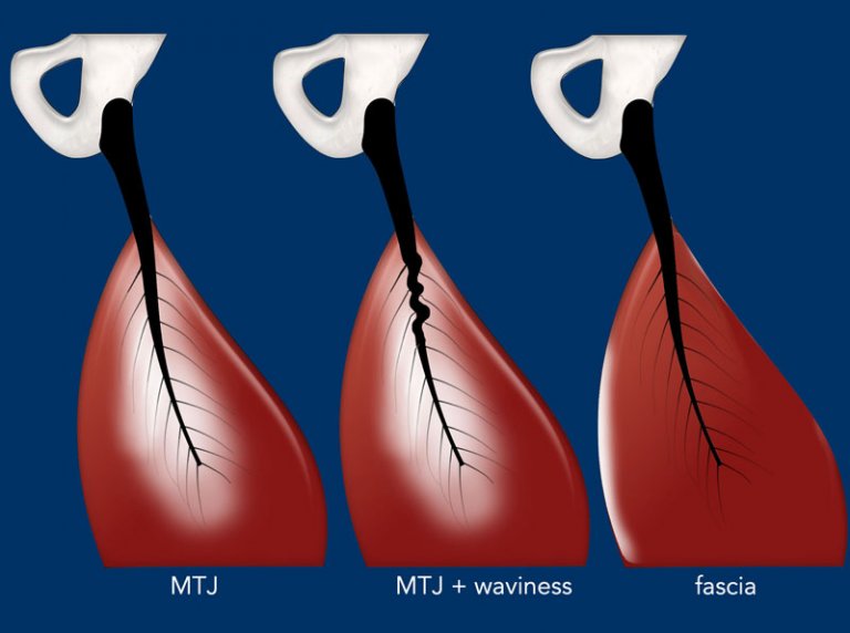 The Radiology Assistant : Hamstring injury