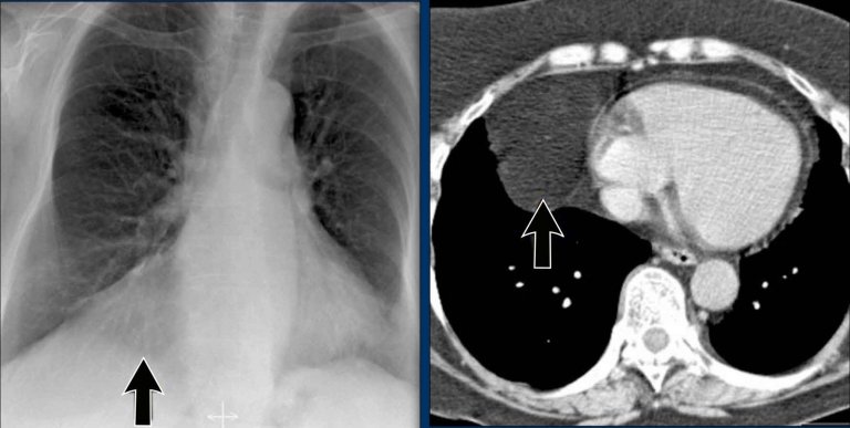 The Radiology Assistant : Chest X-Ray - Basic Interpretation