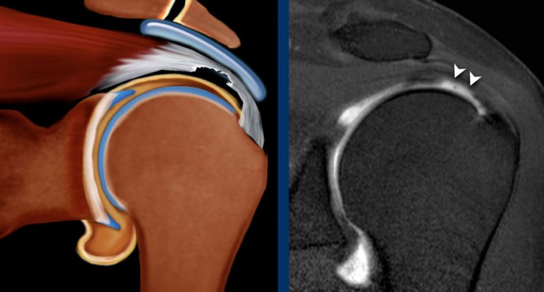 The Radiology Assistant : Shoulder - Rotator cuff injury