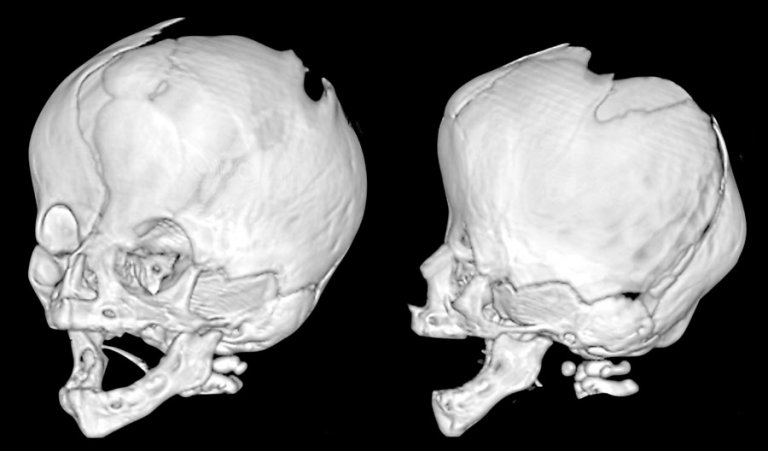 The Radiology Assistant : Craniosynostosis