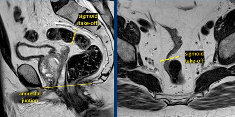 The Radiology Assistant : Rectal Cancer MR staging 3.0