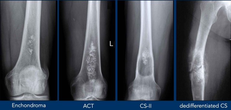The Radiology Assistant : Cartilage tumors