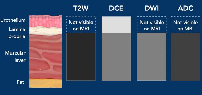 The Radiology Assistant : Bladder Cancer - VI-RADS