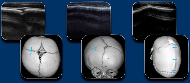 The Radiology Assistant : Craniosynostosis