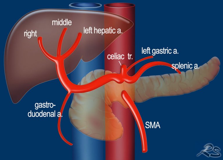 The Radiology Assistant : Pancreatic Cancer - CT staging 2.0