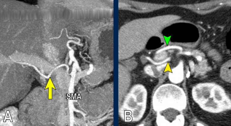 The Radiology Assistant : Pancreatic Cancer - CT staging 2.0