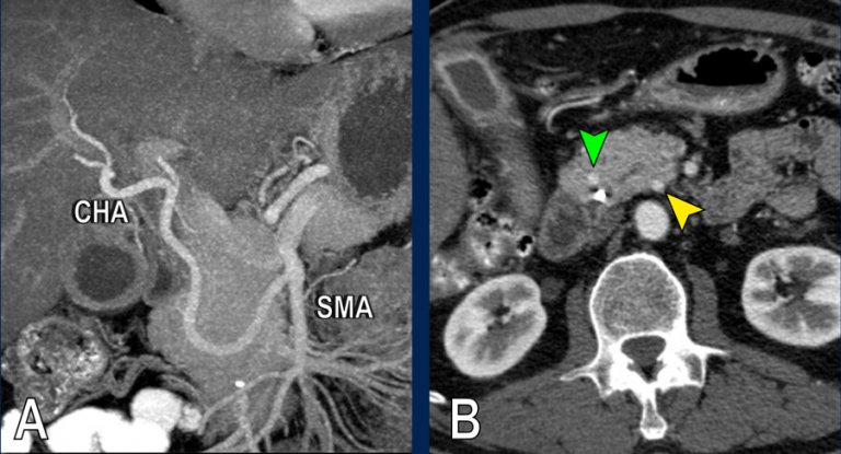 The Radiology Assistant Pancreatic Cancer Ct Staging 2 0