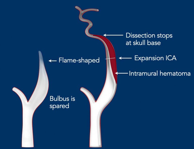 The Radiology Assistant : How to Differentiate Carotid Obstructions