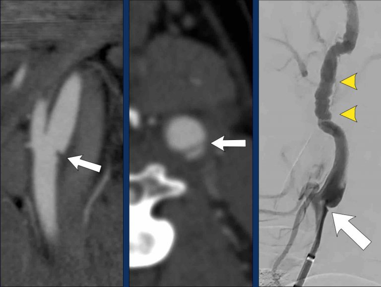 The Radiology Assistant : How to Differentiate Carotid Obstructions
