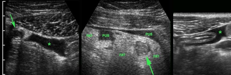 The Radiology Assistant : Appendicitis - US findings