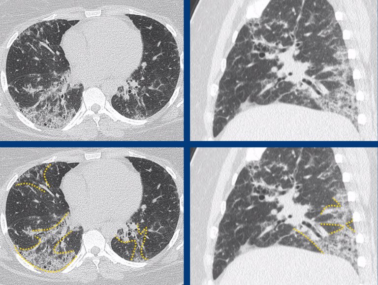 The Radiology Assistant : Pulmonary Fibrosis