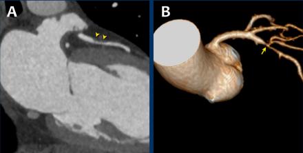The Radiology Assistant : CAD-RADS