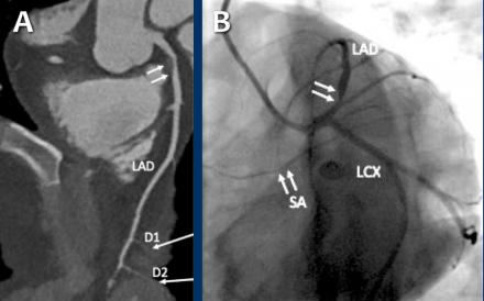 The Radiology Assistant : CAD-RADS