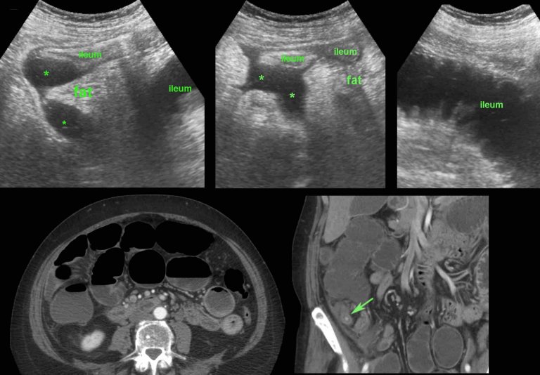 The Radiology Assistant : Appendicitis - US findings