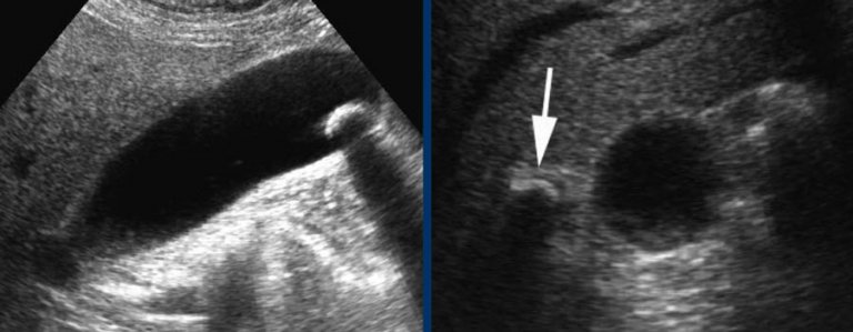 The Radiology Assistant : Gallbladder obstruction