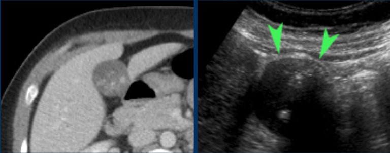 The Radiology Assistant : Gallbladder obstruction