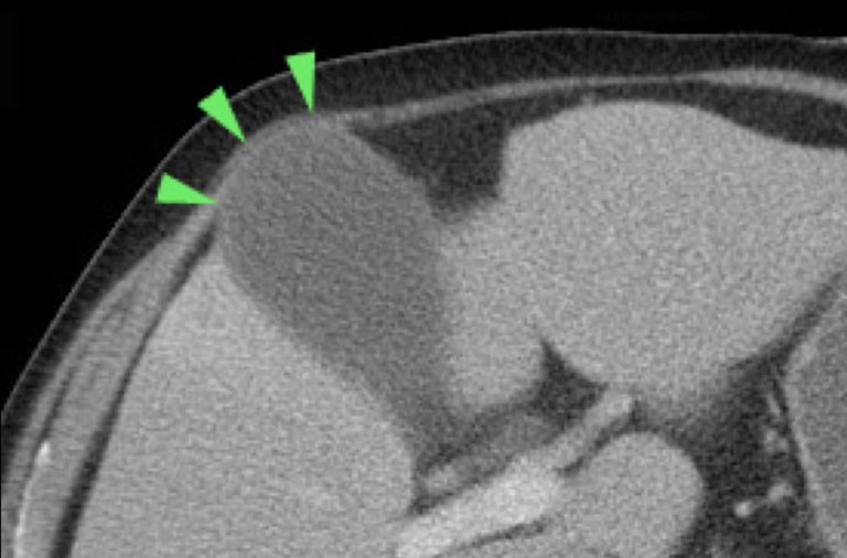 The Radiology Assistant : Gallbladder obstruction