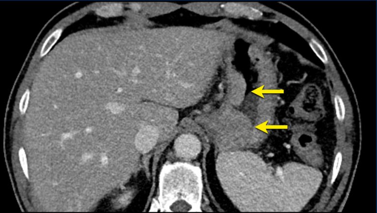 The Radiology Assistant : RECIST 1.1 - and more