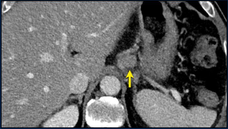 The Radiology Assistant : RECIST 1.1 - and more