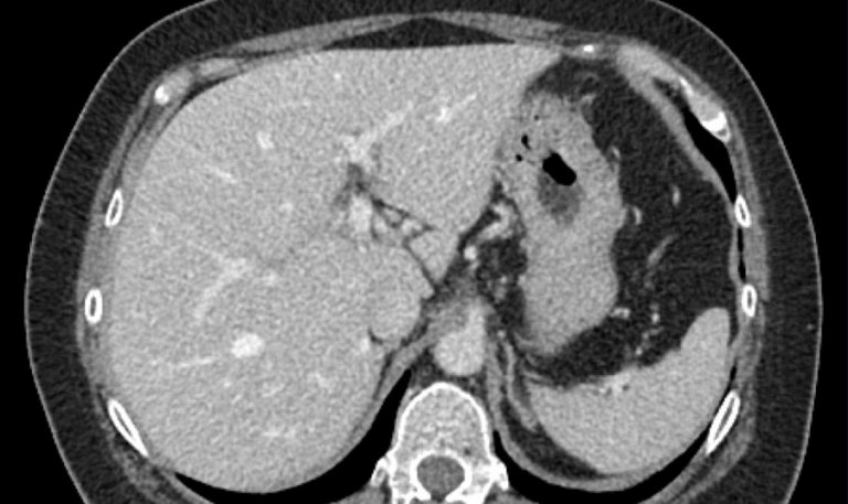 The Radiology Assistant : LI-RADS