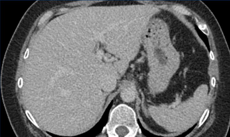 The Radiology Assistant : LI-RADS