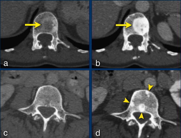 The Radiology Assistant : RECIST 1.1 - the basics
