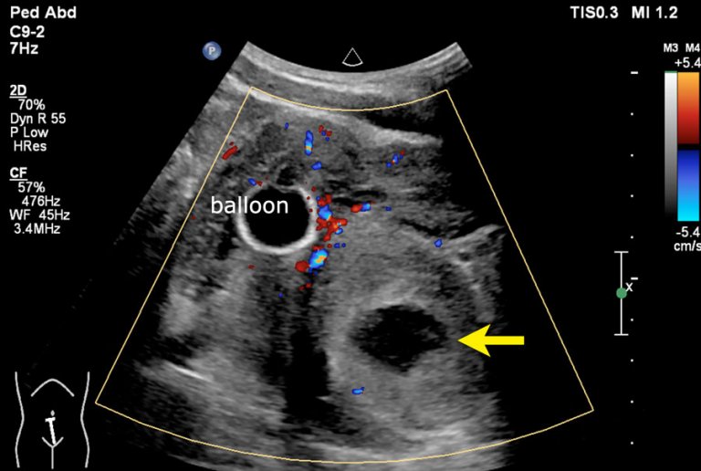 The Radiology Assistant : Solid Abdominal Masses in Children