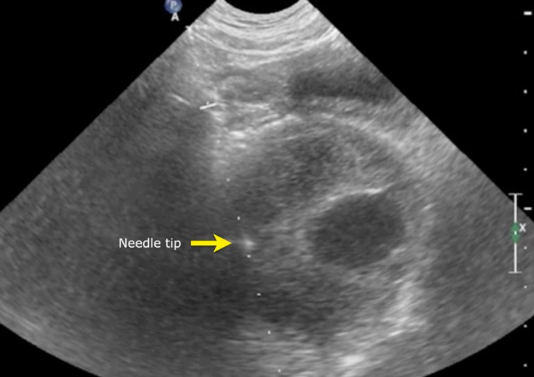 The Radiology Assistant : Solid Abdominal Masses in Children