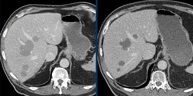 The Radiology Assistant : RECIST 1.1 - and more