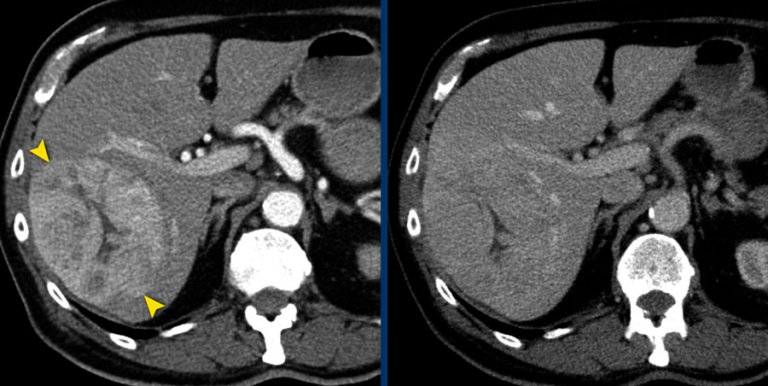 The Radiology Assistant : RECIST 1.1 - and more