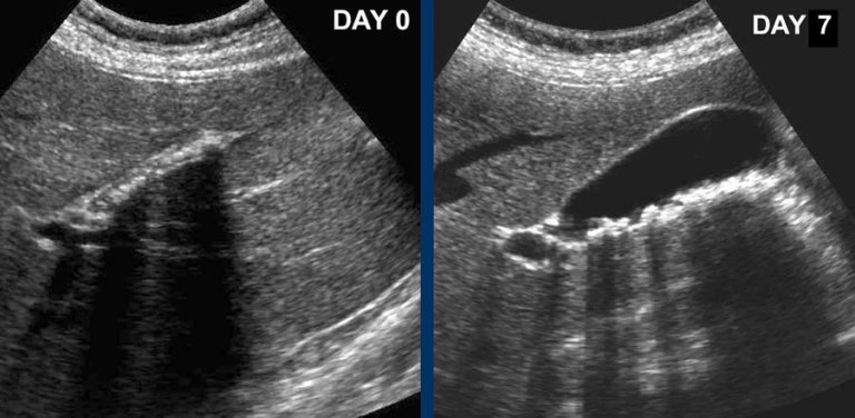 The Radiology Assistant : Gallbladder obstruction