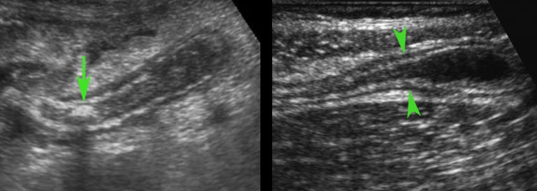 The Radiology Assistant : Appendicitis - US findings
