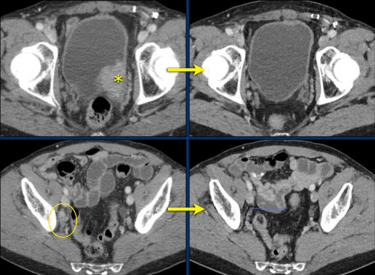 The Radiology Assistant : RECIST 1.1 - examples