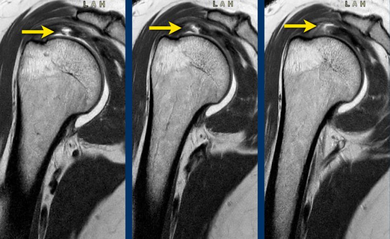 The Radiology Assistant : Shoulder - Rotator cuff injury