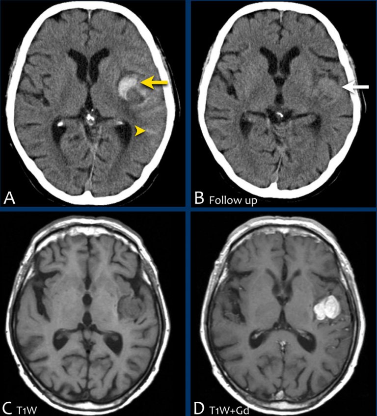 The Radiology Assistant : Non-traumatic Intracranial Hemorrhage