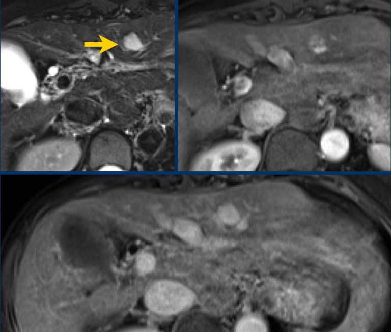 The Radiology Assistant : LI-RADS