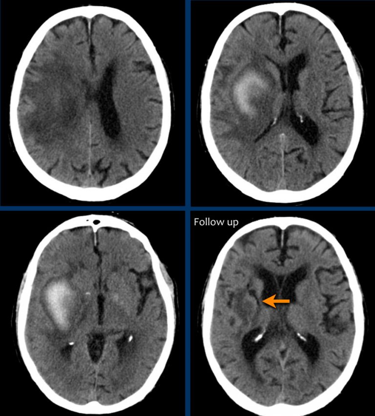 The Radiology Assistant : Non-traumatic Intracranial Hemorrhage